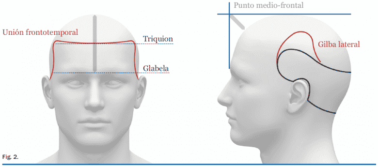 La importancia de un buen diseño en trasplante capilar