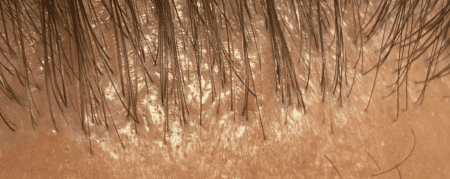 La importancia de un buen diseño en trasplante capilar