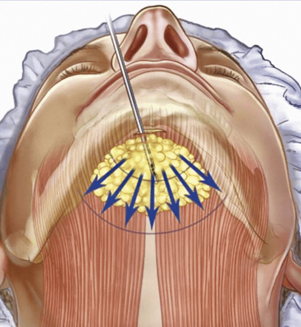 Tratamiento de la papada. Protocolos en sinergia
